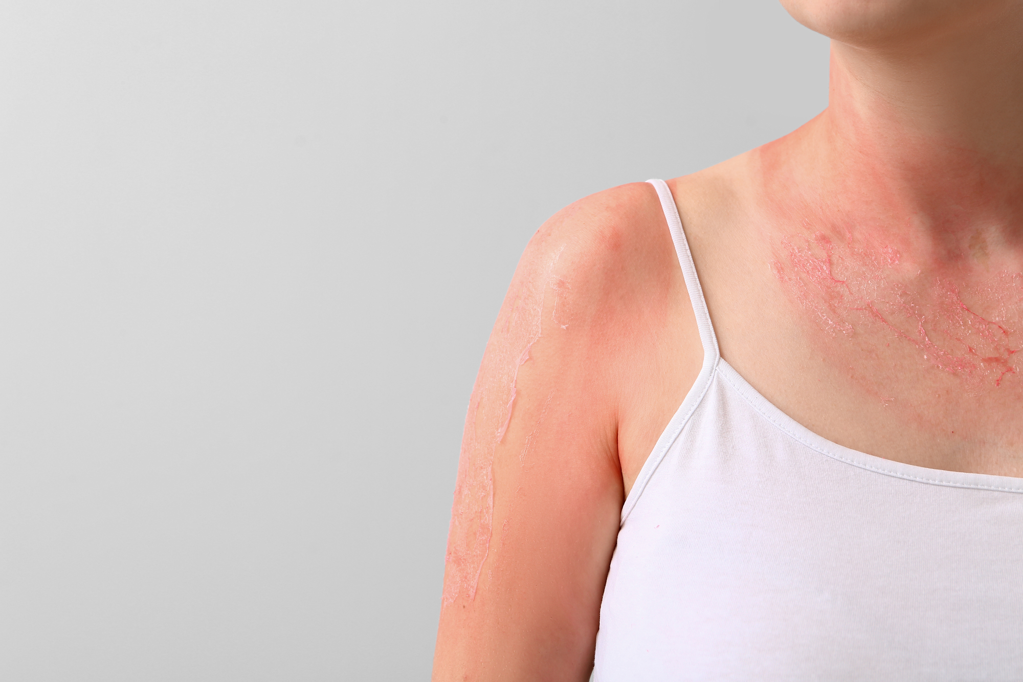 Alergie na slunce - jak vzniká a jak se proti ní bránit? | Gofit.cz